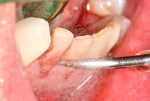 Gingivitis Explained - Dental Aware Australia