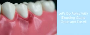 Red Gums: Your Guide to Eliminating Them for Good - Dental Aware Australia