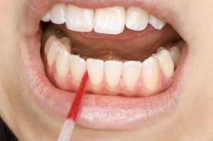 Red Gums: Your Guide to Eliminating Them for Good - Dental Aware Australia