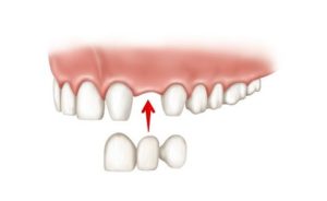 Dental Bridges: The Definitive Guide (2020) - Dental Aware Australia