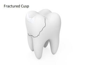 What to Do When Your Tooth is Fractured? - Dental Aware Australia