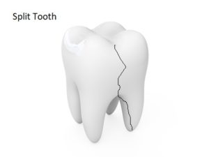 What to Do When Your Tooth is Fractured? - Dental Aware Australia