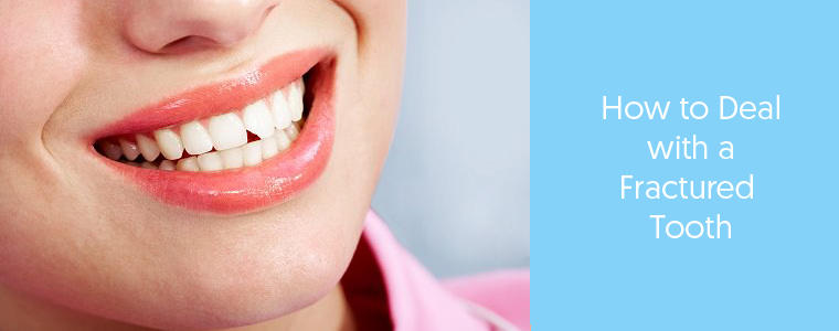 Tooth Fracturecracked Tooth Causes Diagnosis And Treatments