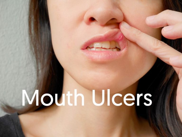 Mouth Ulcers - Everything Covered | Dental Aware Australia