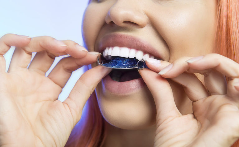 Wearing Retainers – The Definitive Guide - Dental Aware Australia